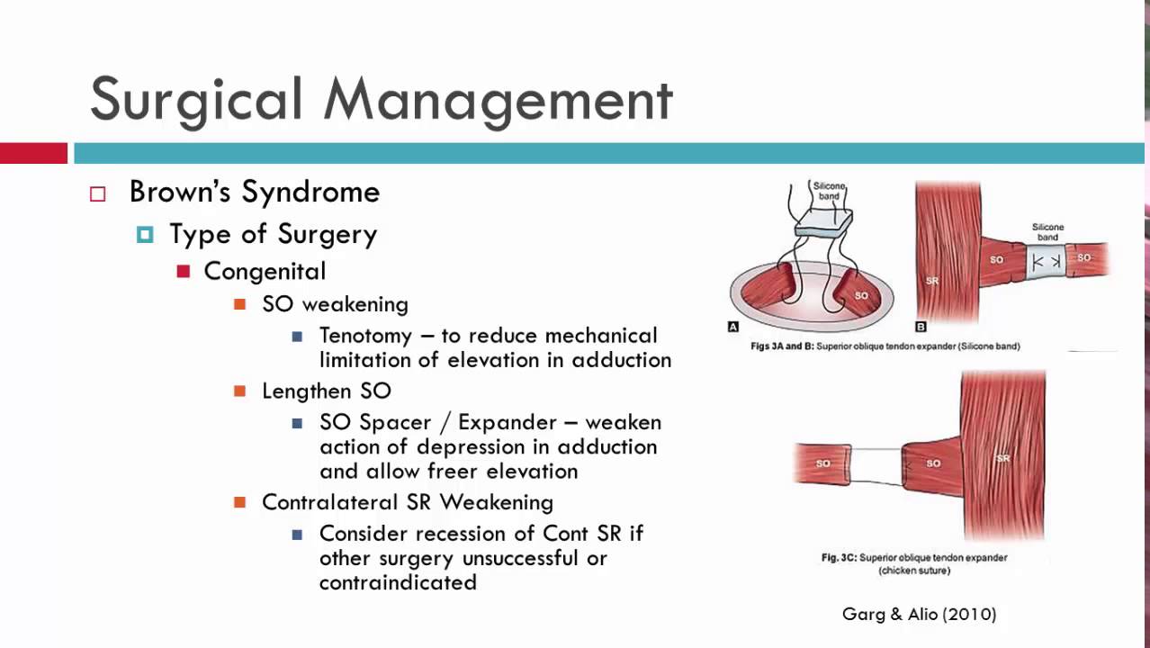 Superior Oblique Tenotomy Superior Labral Anterior Posterior Lesions