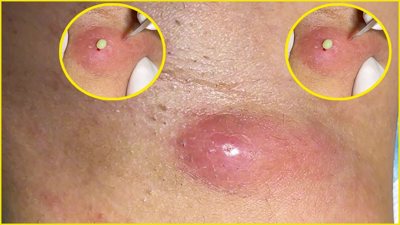 Botfly Maggot Removal Inflammatory Acne Relax Every Day With Satisfying ...