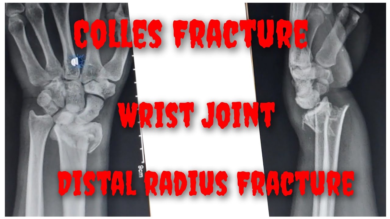 Colles Fracture || Distal Radius Fracture || Wrist Joint X-ray || Wrist ...
