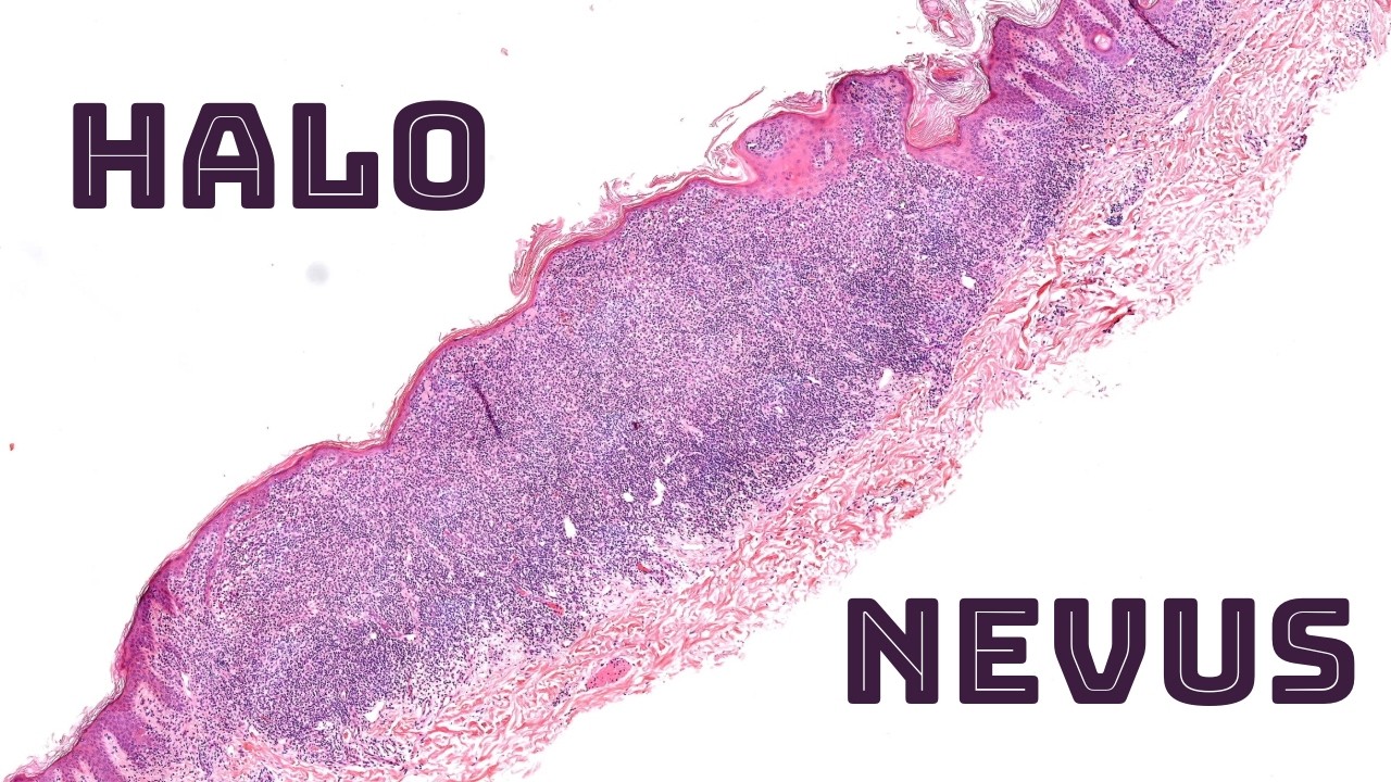 Halo nevus (nevus with brisk inflammation -brown skin spot with white pale halo around it ...