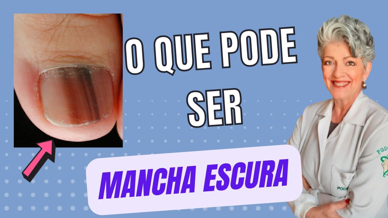 Risco Escuro Na Unha - RETOEDU