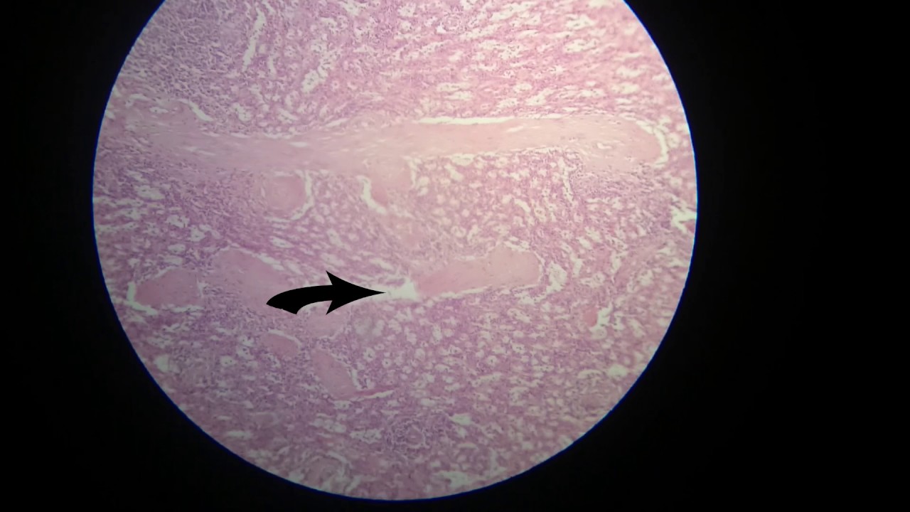 Chronic Venous Congestion of The Spleen Histopathology - YouTube