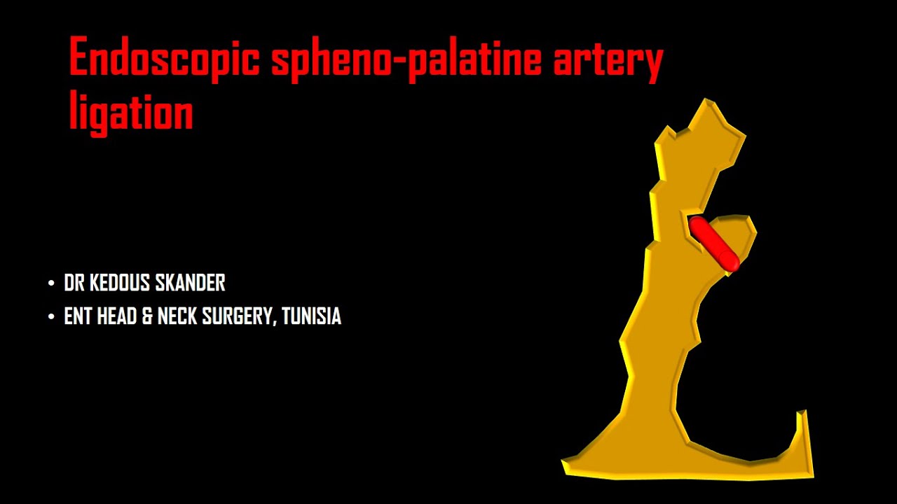endoscopic endonasal sphenopalatine artery ligation - YouTube