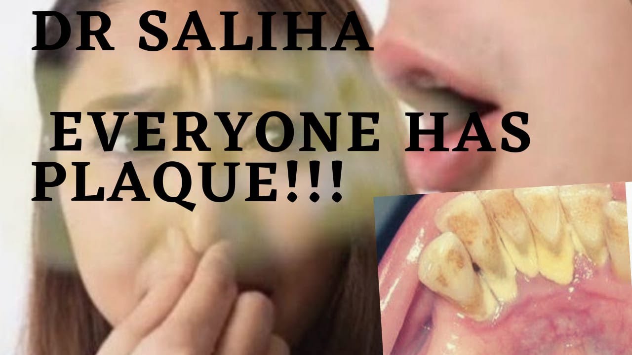 DENTAL PLAQUE -CAUSES,SYMPTOMS ,COMPLICATIONS AND TREATMENT - YouTube