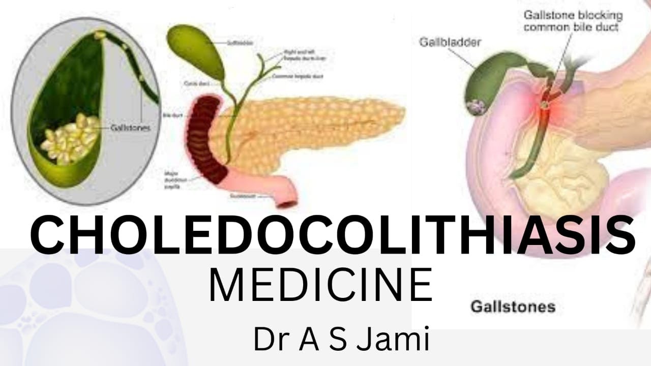 Choledocolithiasis/STONE IN CBD || Medicine Lecture || GALL BLADDER ...