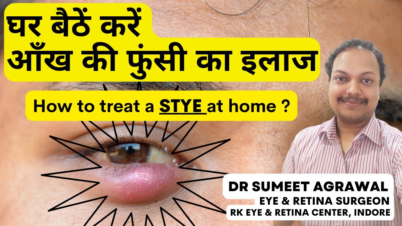 How to treat a STYE at home ? घर पर करें आँख की फुंसी का इलाज l - YouTube