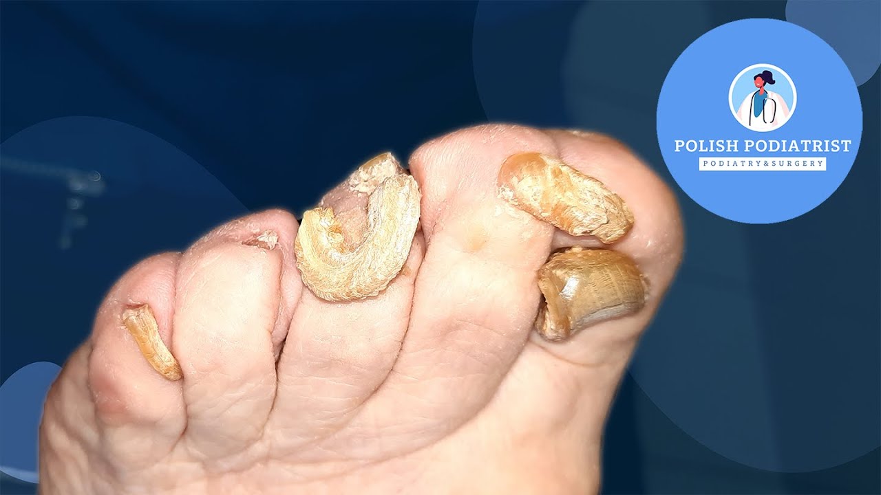 Neglected nails PART 1 / Oczyszczenie zaniedbanych paznokci cz 1 - YouTube