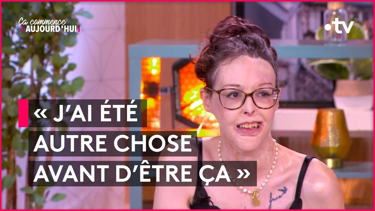 Déborah est grande brûlée : "vivre dans un corps usé jusqu'à l'os" - Ça ...