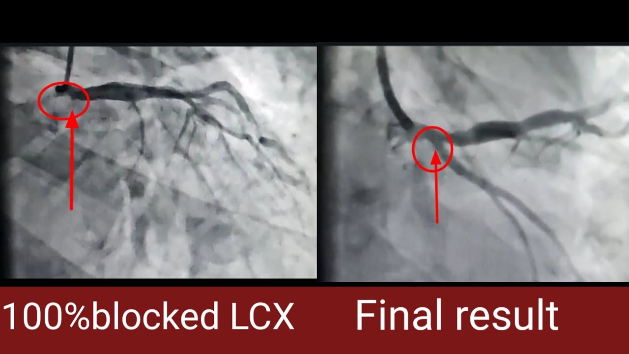 Heart attack with 100% block in LCX II LCX opened with one stent II ...
