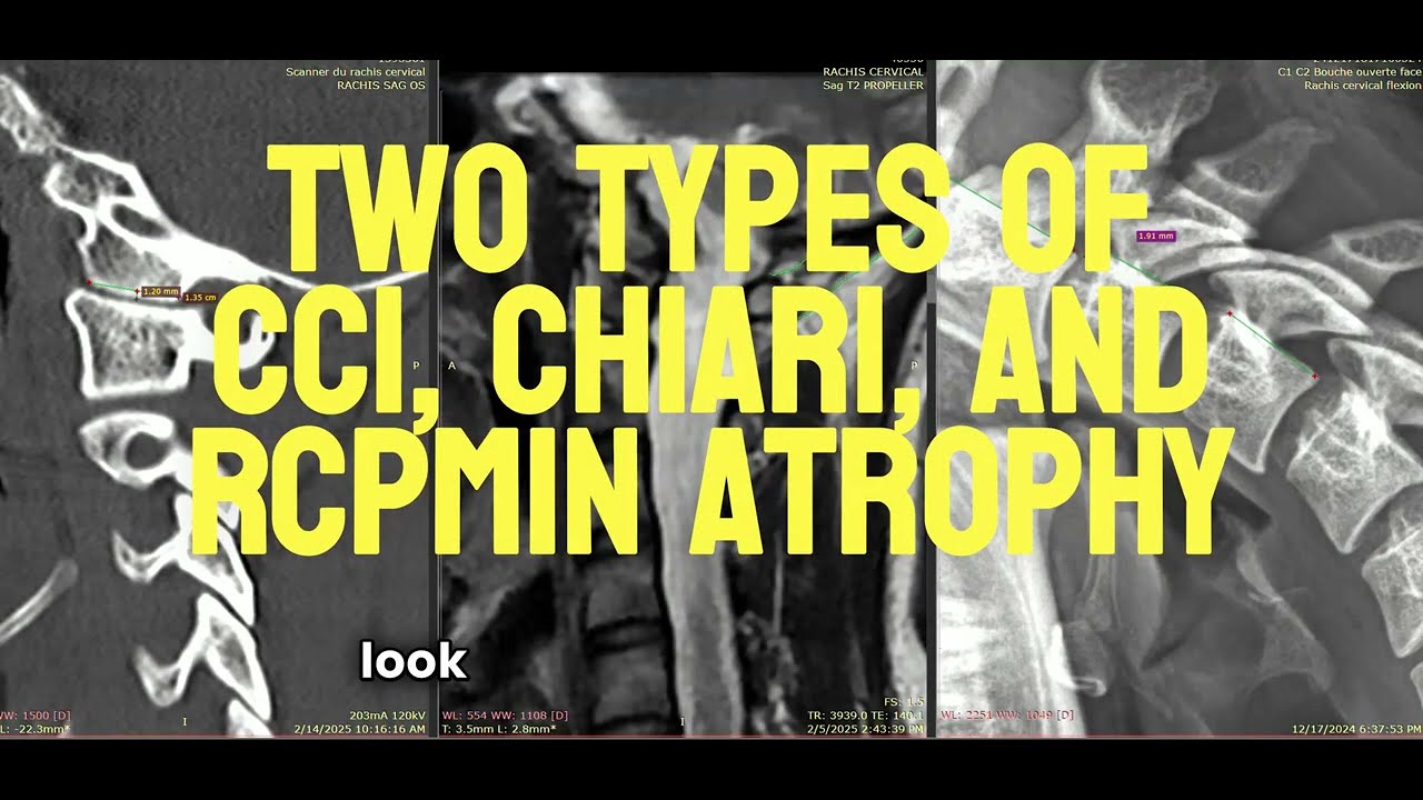 Two Types of CCI, Chiari, and PCPMin Atrophy - YouTube