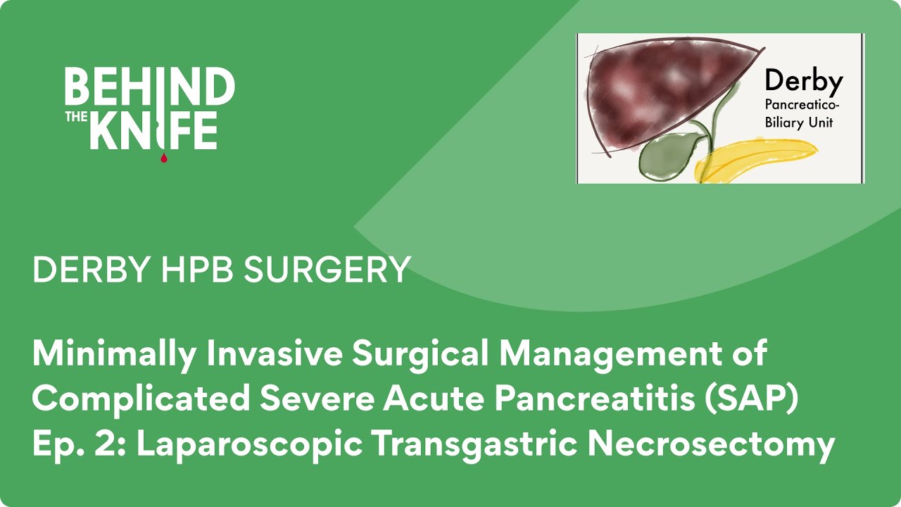 Derby HPB Surgery - Severe Acute Pancreatitis Ep. 2: Laparoscopic ...