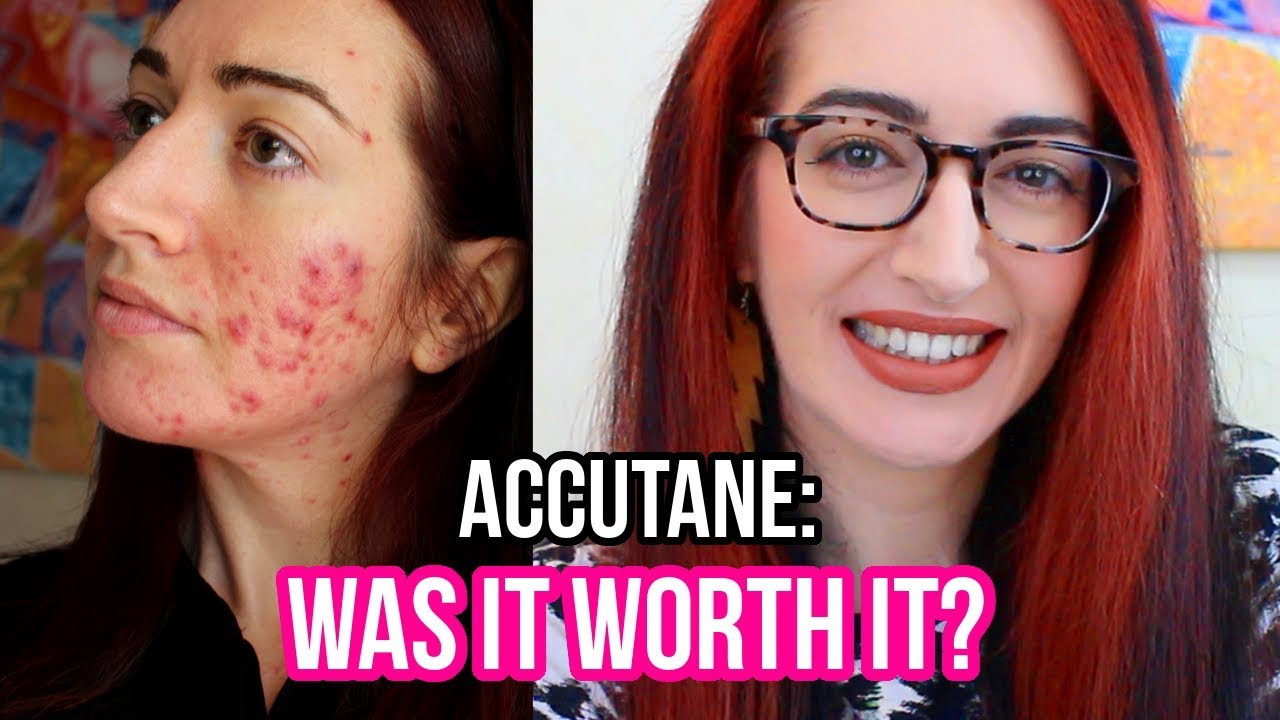 My FINAL Accutane Update (I hope...) Results: What's Good & What's BAD ...