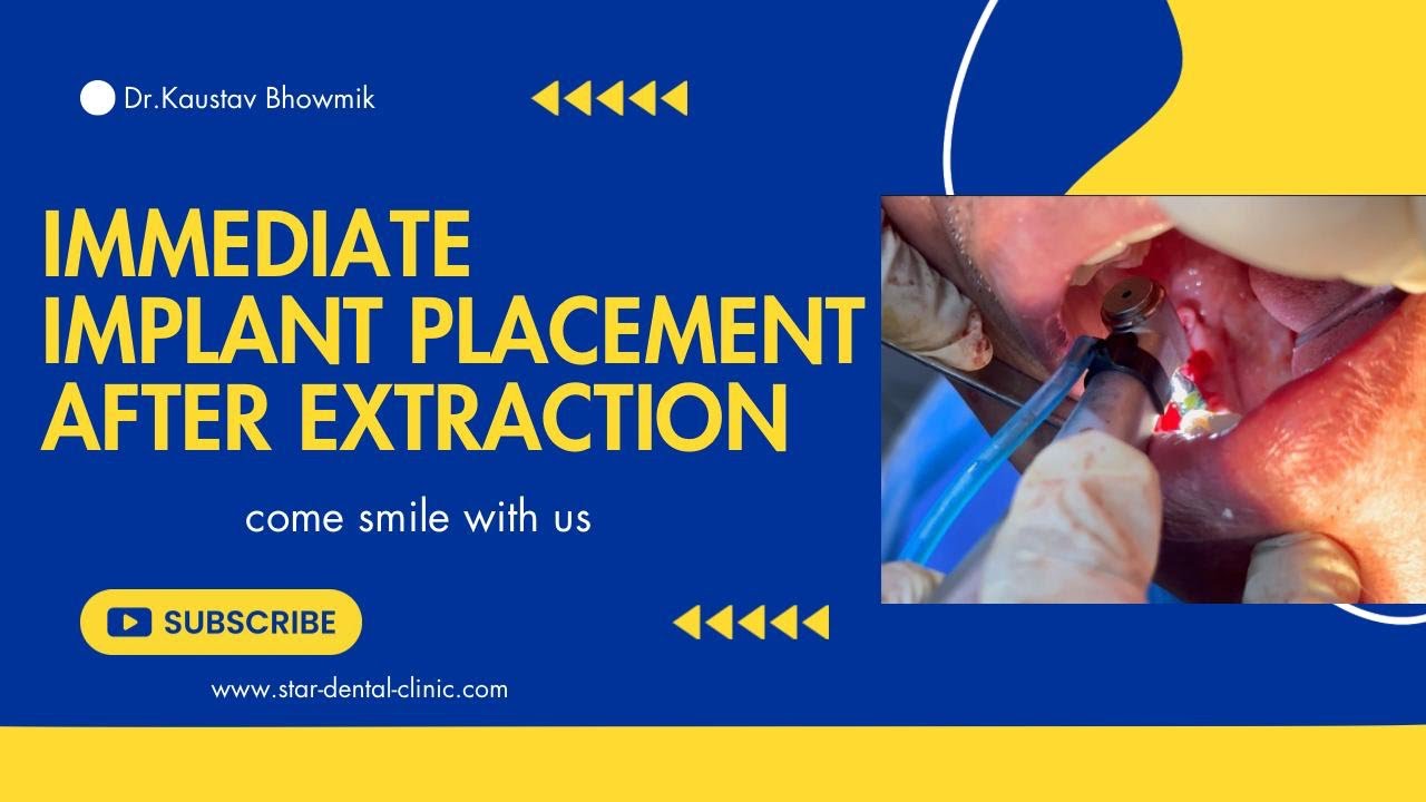 Immediate Implant placement after extraction @StarDentalClinic_slg ...