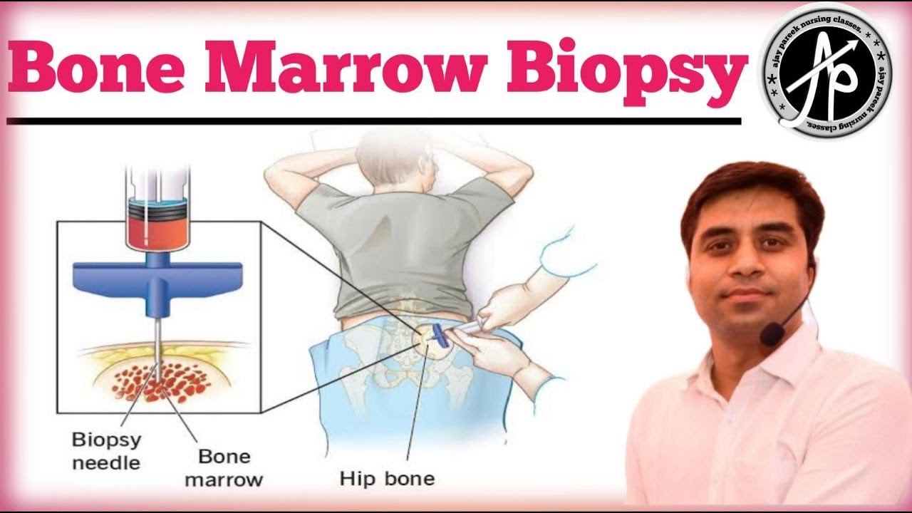 bone marrow biopsy - YouTube