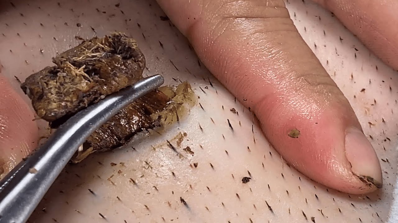 [ASMR] Sharp Ingrown Trimmed! Professional Pedicure DR LEE’S ULTIMATE ...