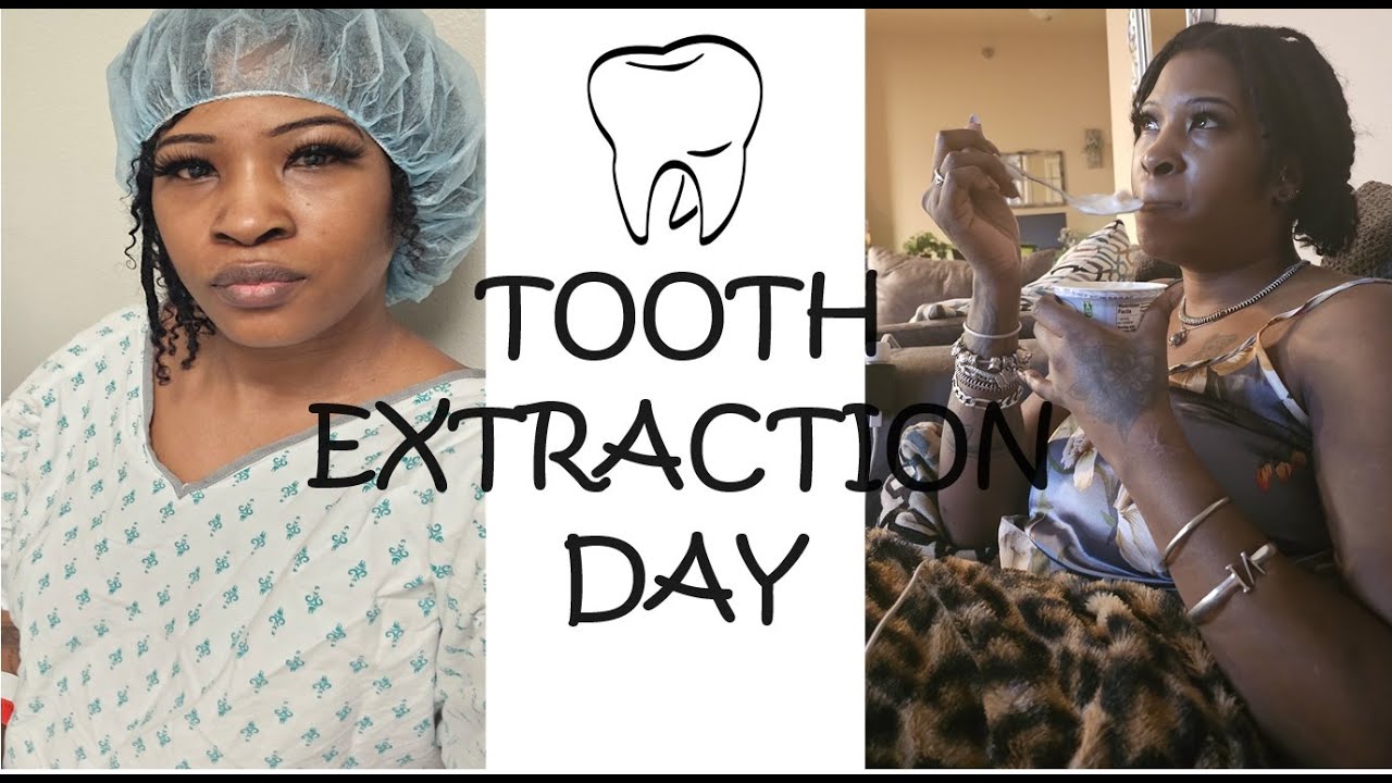 MY POST-TOOTH EXTRACTION DAY!! - YouTube