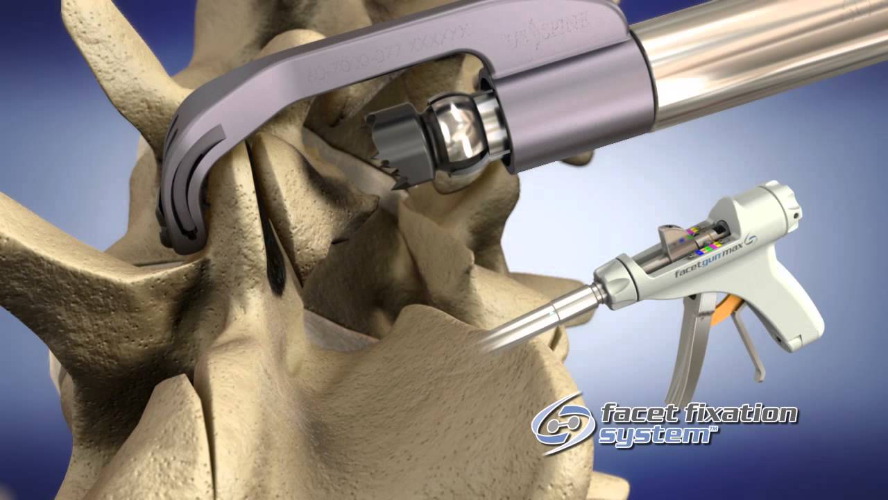 The FacetGun Max Facet Fixation System - YouTube