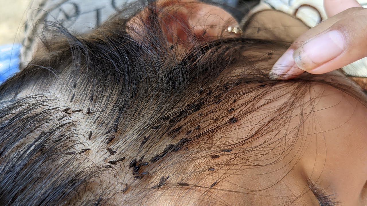 Comb a lot of big lice from long hair - How to get rid some of head ...