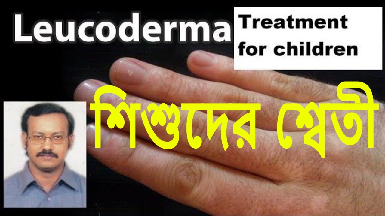 leucoderma hereditary? leucoderma vitiligo treatment for children in ...