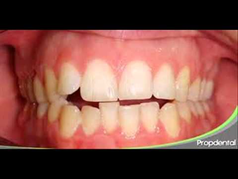 Trauma Oclusal - YouTube