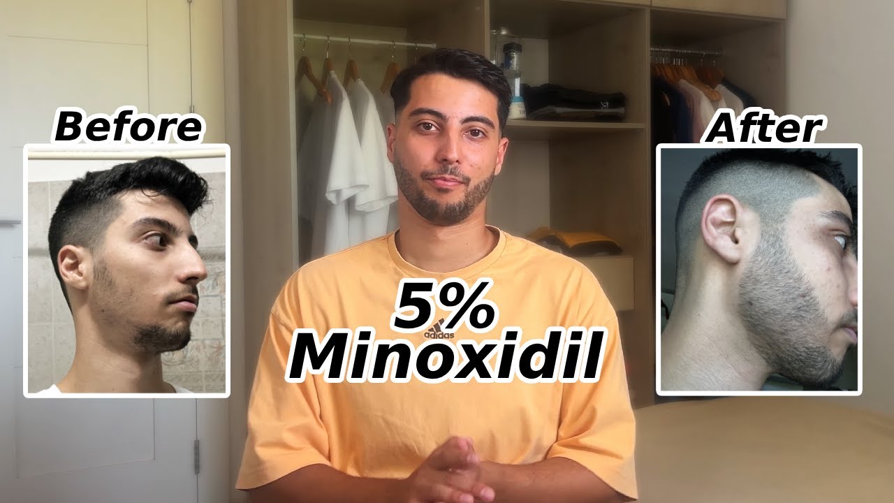 How I Grew My Beard At 25 - YouTube