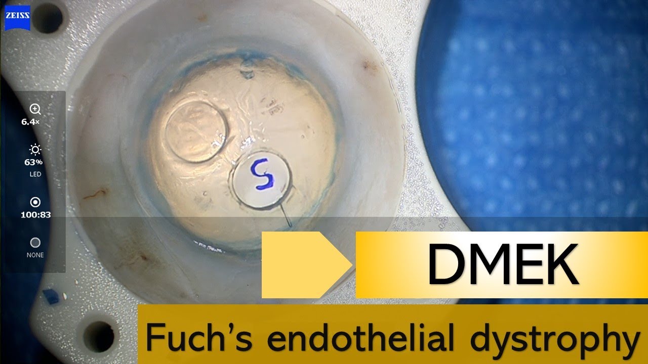 DMEK Corneal Transplant - Management of Fuch's Endothelial Dystrophy ...