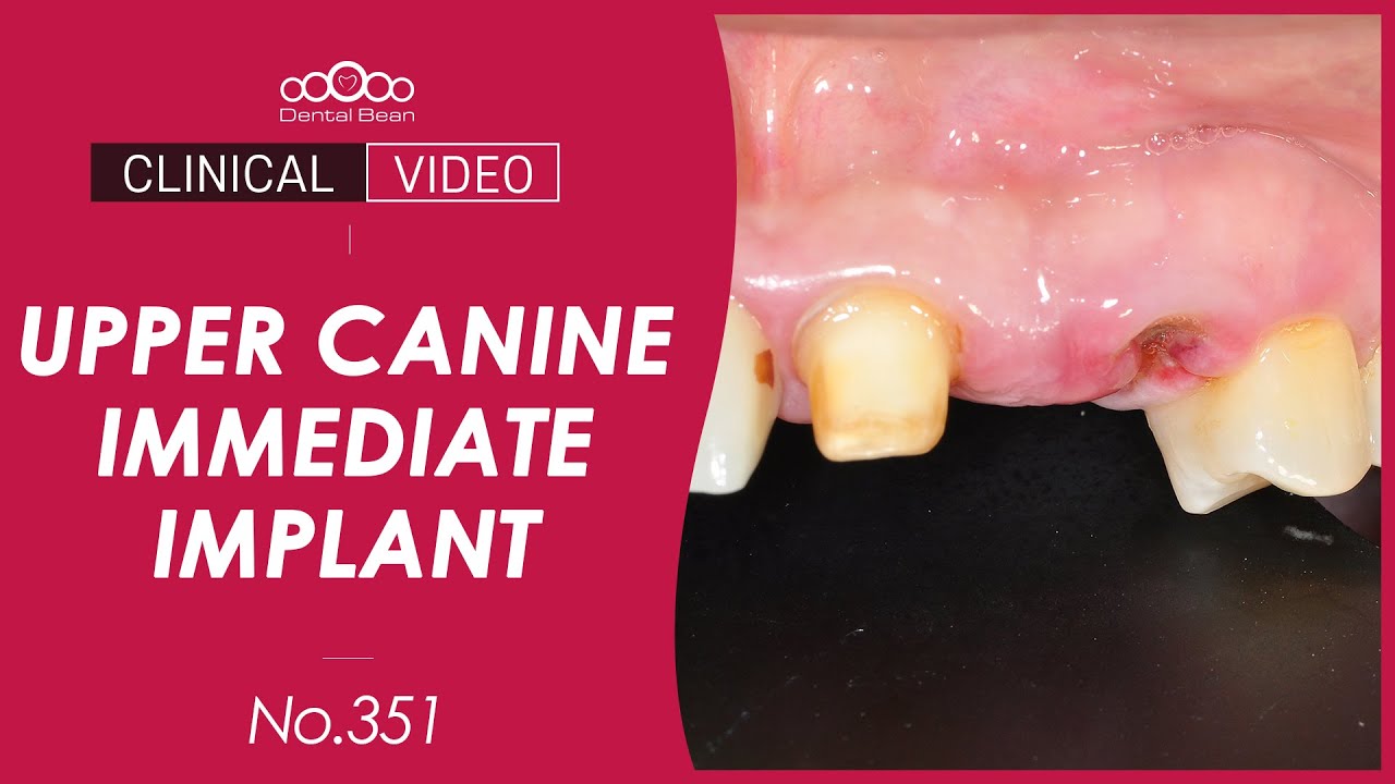 Upper canine immediate placement & restoration [Dr. Kim Jaeyoon] - YouTube