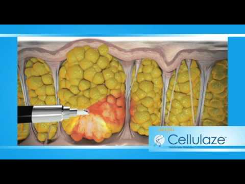 Dr. Sean Rice - Cellulaze - Rice Cosmetic Surgery - YouTube