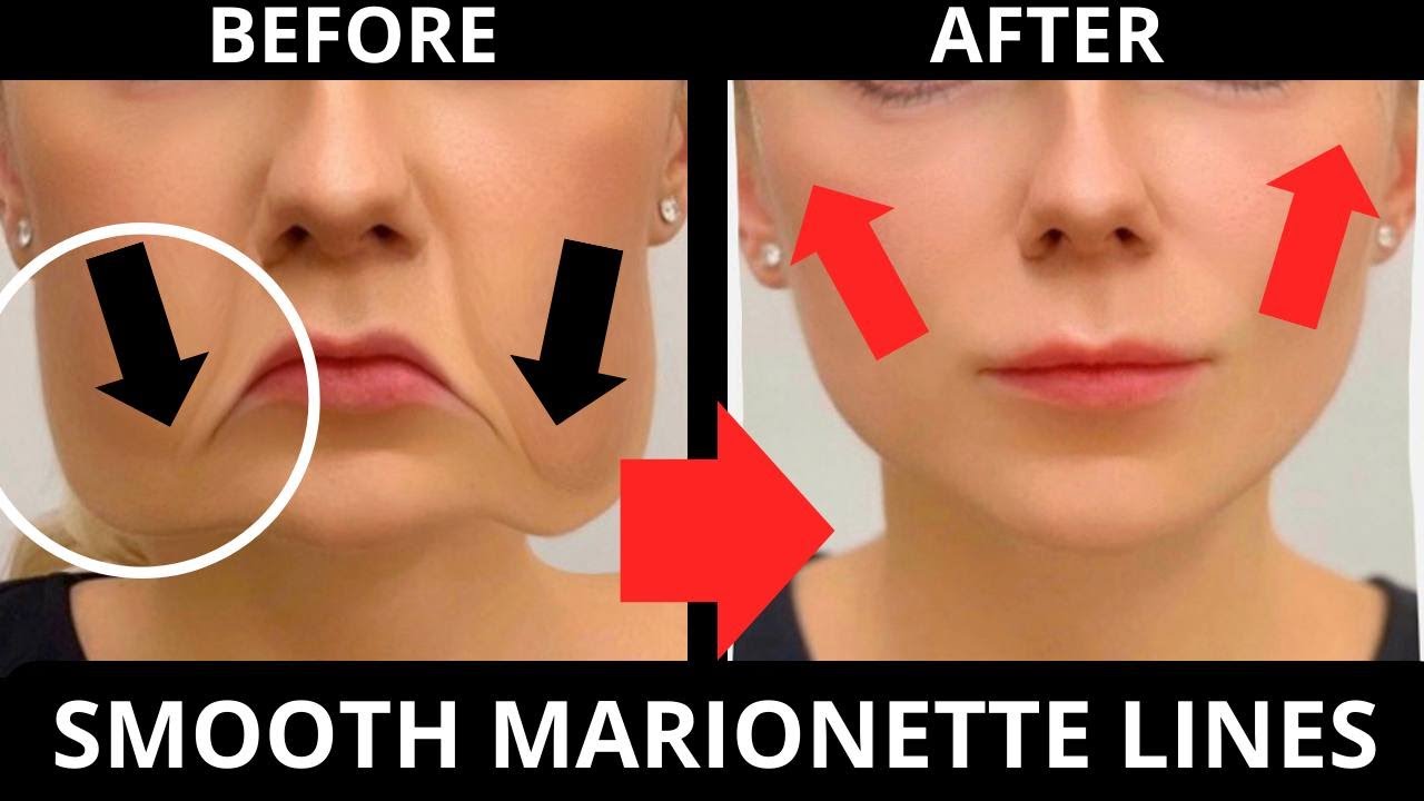 🛑 MARIONETTE LINES ! FACE EXERCISES FOR NASOLABIAL FOLDS (LAUGH LINES ...
