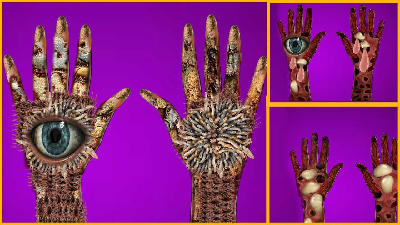 ASM hands got worms | ASMR worms treatment - YouTube