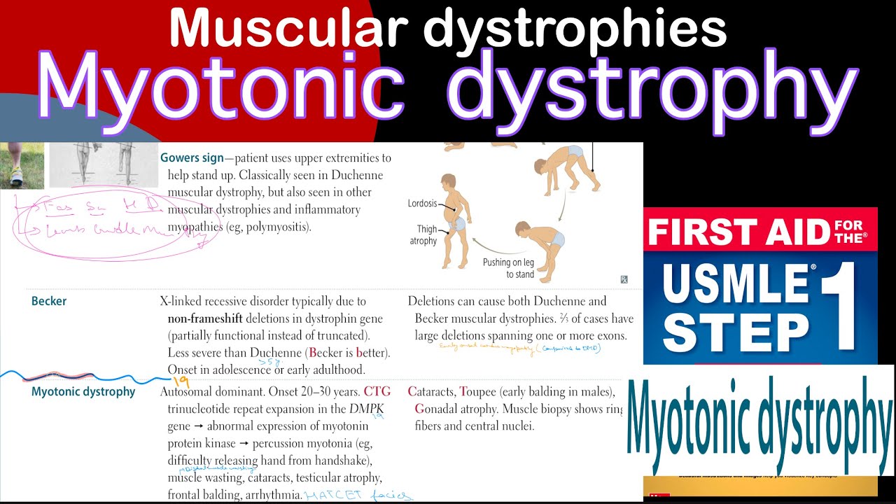 Myotonic dystrophy in Hindi/Urdu by first aid for USMLE step 1 - YouTube