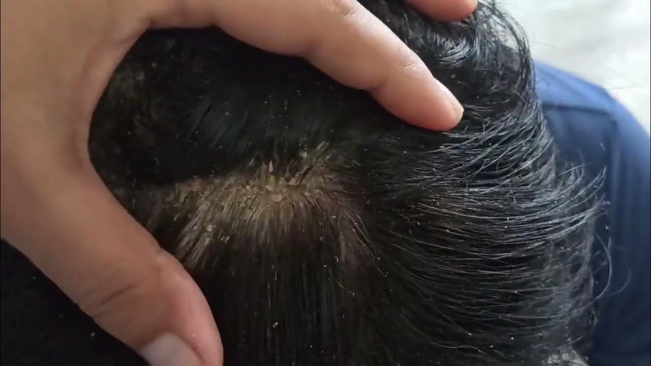 Scratching Dandruff !! October 14, 2022 - YouTube