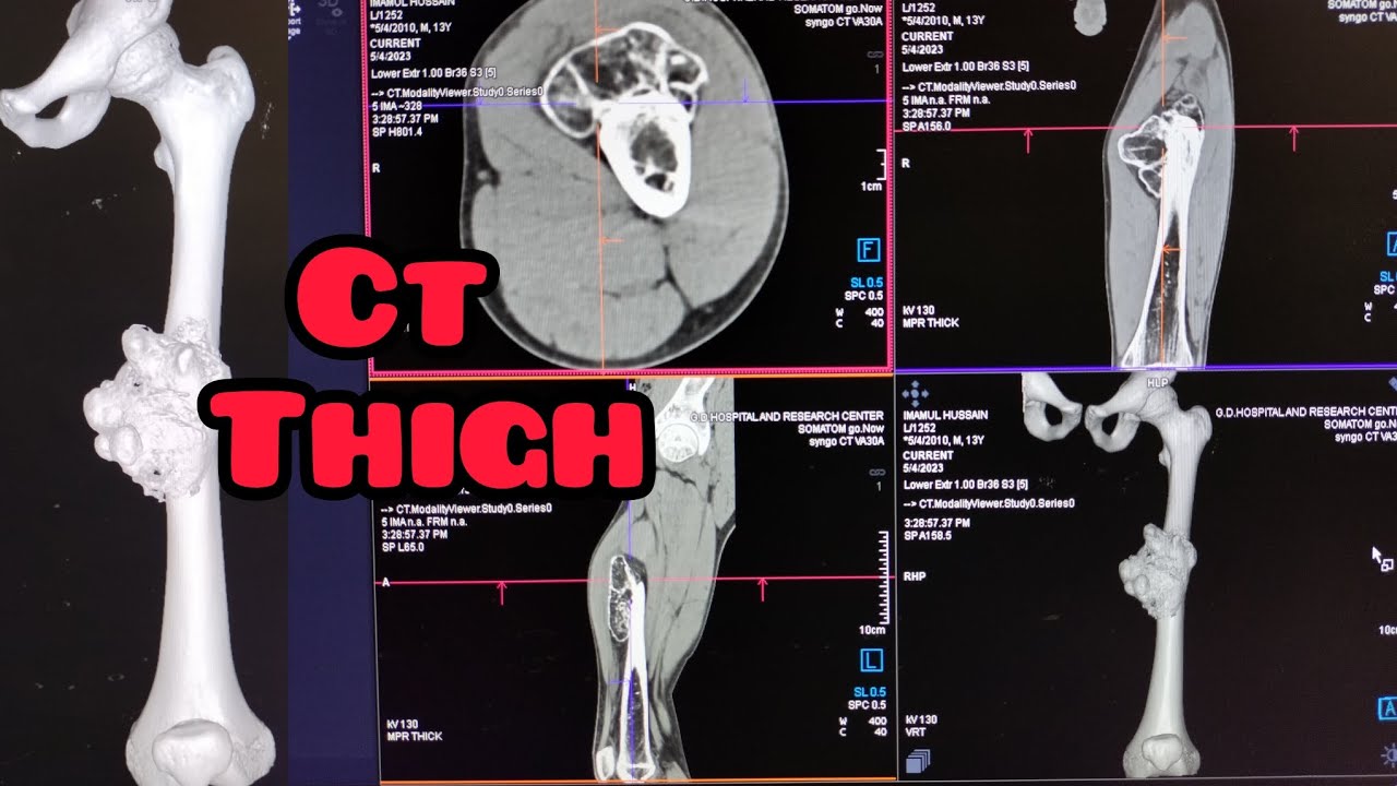 Ct scan Thigh,ct scan femur,,Somatom go - YouTube