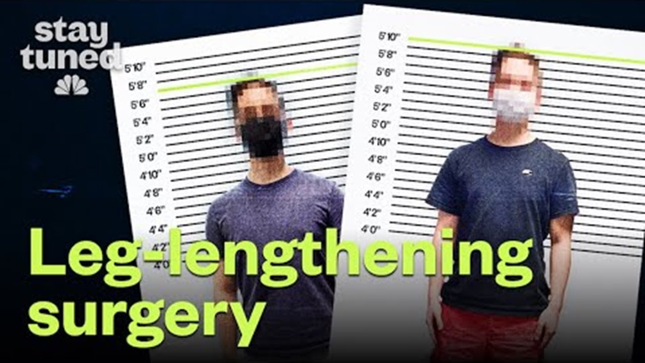 Leg lengthening Surgery Helped This Man Go From 5 7 To 5 10 Was It Leg lengthening Surgery Helped This Man Go From 5 7 To 5 10 Was It