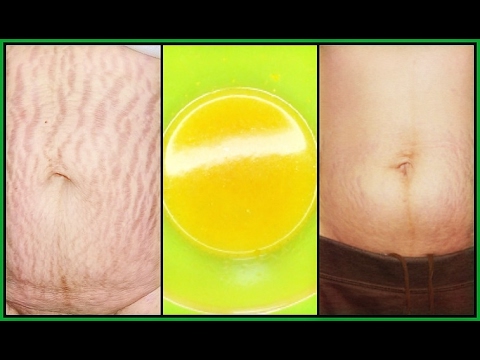USE THIS POWERFUL HOMEMADE TREATMENT TO ERASE STRETCH MARKS NATURALLY ...
