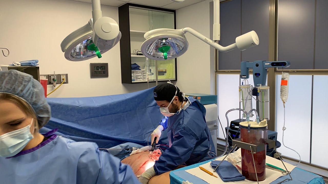 Bbl surgery part 2 with Dr. Latin heat - YouTube