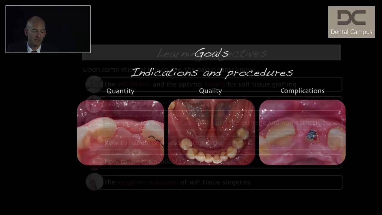 Soft Tissue Management in Implant Dentistry - YouTube