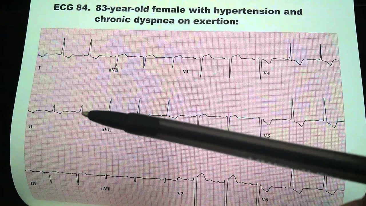 EKG ECG electrocardiogram Cardiologist Cardiology www.drbenzur.com ...