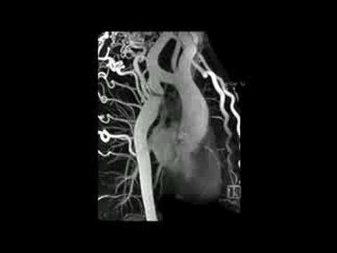 Cardiac MRI - Maximum intensity projection (MIP) - YouTube