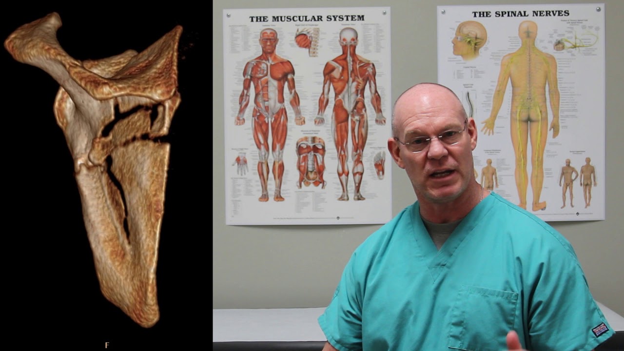 Shoulder Blade (Scapula) Fractures | Fracture Friday Episode 29 - YouTube
