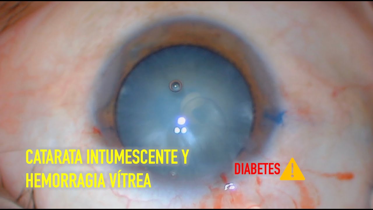 Cirugía de catarata intumescente y hemorragia vítrea en un paciente con ...
