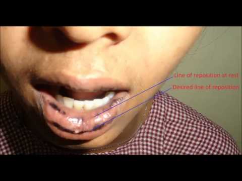Lip reduction india cheiloplasty aurangabad - YouTube