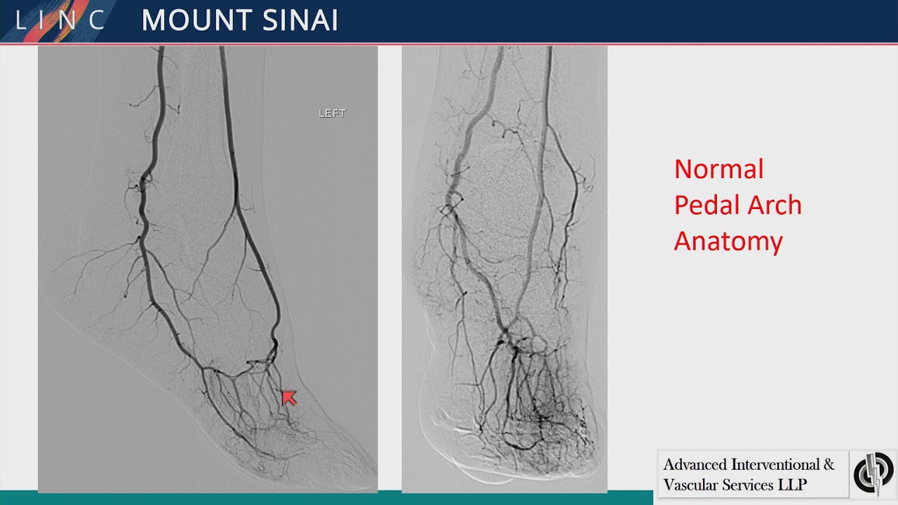 Angiographic Anatomy of BTK Vessels and Pedal-Plantar Loop - YouTube