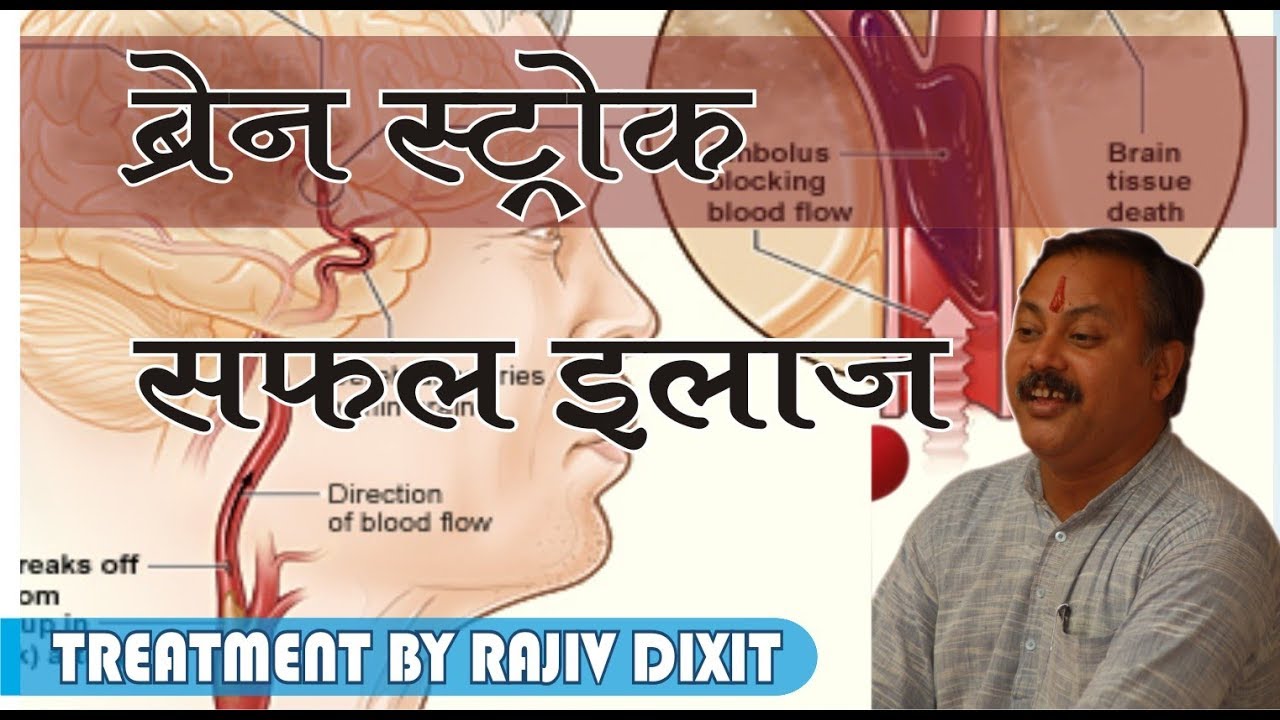 Rajiv Dixit TREATMENT OF BRAIN STROKE YouTube rajiv-dixit-treatment-of-brain-stroke-youtube