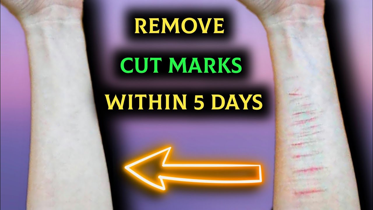 How To Remove Cut Marks Permanently How To Remove Scars YouTube How To Remove Cut Marks Permanently How To Remove Scars YouTube