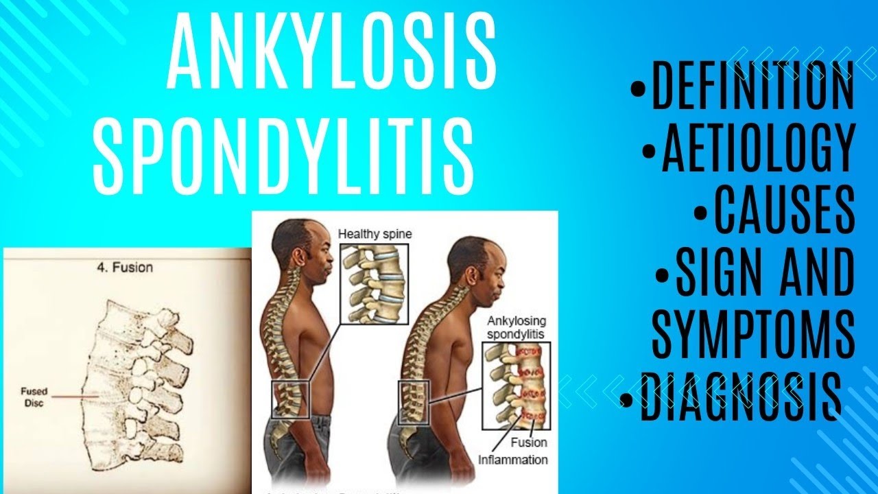 Ankylosis spondylitis - Definition, Aetiology, Causes, Sign & symptoms ...