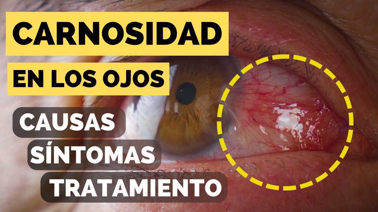 Carnosidad en los Ojos, Causas, Síntomas y Tratamiento Definitivo de ...