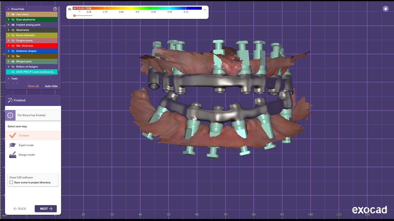 Upper & lower titanium bar designing (digital protocol) for simpladent ...
