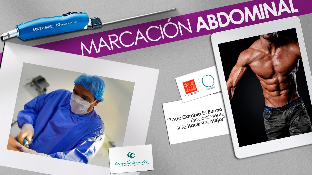 "Lipo HD 4K: ¡Abdomen Definido y Esculpido! | Cirugía Plástica ...