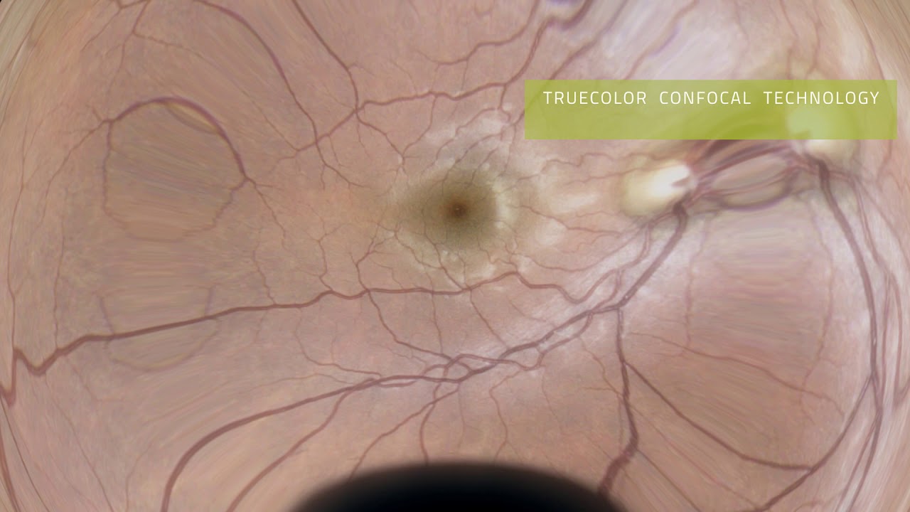 CENTERVUE DRSplus Product Video - YouTube